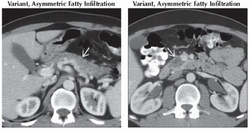 DA12-DB1-Atrophy_or_Fatty_Replacement_of_Pancreas-FFU4.gif | Abdominal Key