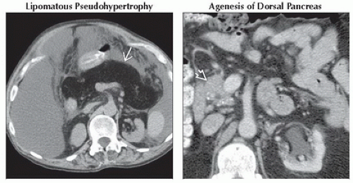 DA12-DB1-Atrophy_or_Fatty_Replacement_of_Pancreas-FFU5.gif | Abdominal Key