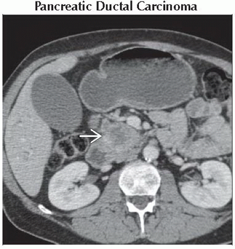 DA12-DB1-Dilated_Pancreatic_Duct-FFU2.gif | Abdominal Key