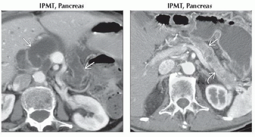 DA12-DB1-Dilated_Pancreatic_Duct-FFU4.gif | Abdominal Key