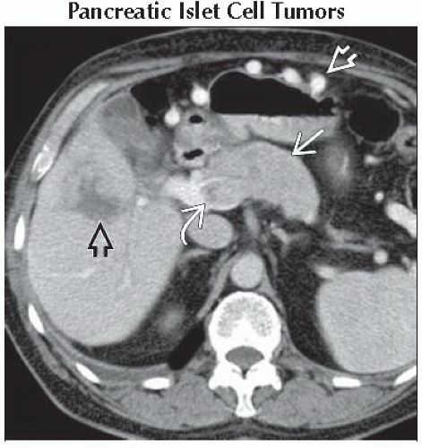 DA12-DB1-Hypervascular_Pancreatic_Mass-FFU2.gif | Abdominal Key
