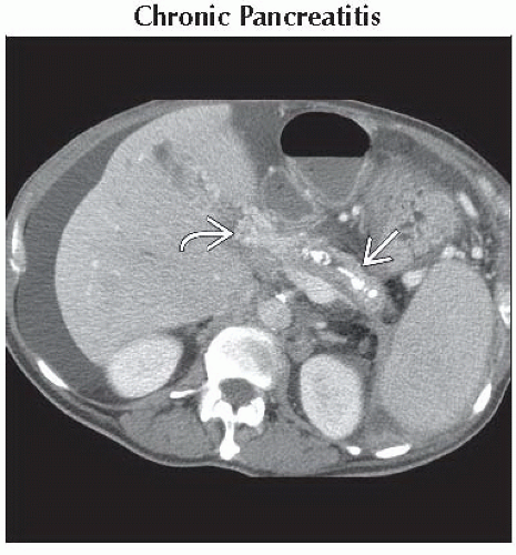 DA12-DB1-Pancreatic_Calcifications-FFU1.gif | Abdominal Key