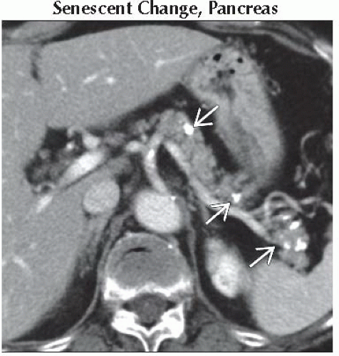 DA12-DB1-Pancreatic_Calcifications-FFU2.gif | Abdominal Key