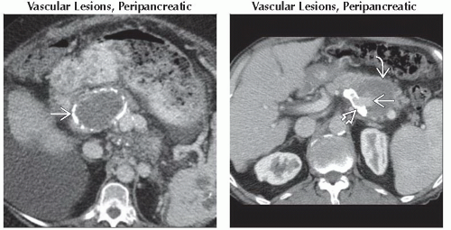 DA12-DB1-Pancreatic_Calcifications-FFU3.gif | Abdominal Key