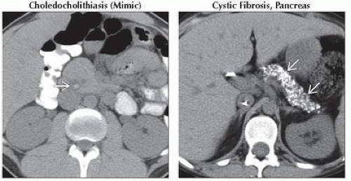 DA12-DB1-Pancreatic_Calcifications-FFU4.gif | Abdominal Key