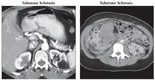DA15-DB1-Bilateral_Renal_Cysts-FFU7.gif | Abdominal Key
