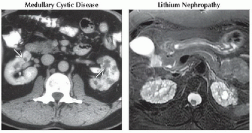 DA15-DB1-Bilateral_Renal_Cysts-FFU8.gif | Abdominal Key