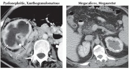 DA15-DB1-Dilated_Renal_Calices-FFU12.gif | Abdominal Key