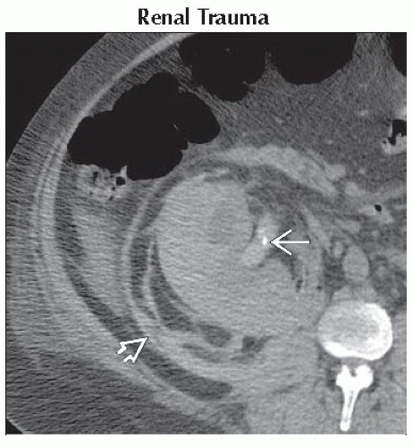 DA15-DB1-Perirenal_Hemorrhage-FFU2.gif | Abdominal Key