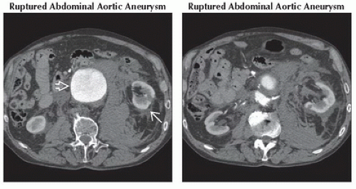 DA15-DB1-Perirenal_Hemorrhage-FFU4.gif | Abdominal Key