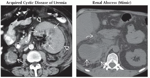 DA15-DB1-Perirenal_Hemorrhage-FFU6.gif | Abdominal Key