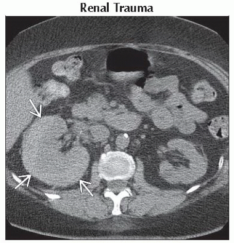 DA15-DB1-Perirenal_and_Subcapsular_Mass_Lesions-FFU1.gif | Abdominal Key