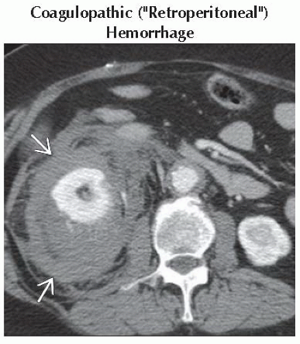 DA15-DB1-Perirenal_and_Subcapsular_Mass_Lesions-FFU2.gif | Abdominal Key