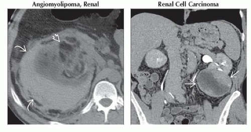 DA15-DB1-Perirenal_and_Subcapsular_Mass_Lesions-FFU3.gif | Abdominal Key