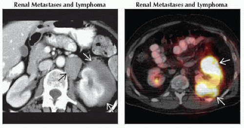DA15-DB1-Perirenal_and_Subcapsular_Mass_Lesions-FFU4.gif | Abdominal Key