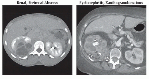 DA15-DB1-Perirenal_and_Subcapsular_Mass_Lesions-FFU5.gif | Abdominal Key
