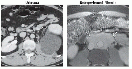 DA15-DB1-Perirenal_and_Subcapsular_Mass_Lesions-FFU7.gif | Abdominal Key