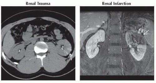 DA15-DB1-Wedge_shaped_or_Striated_Nephrogram-FFU4.gif | Abdominal Key