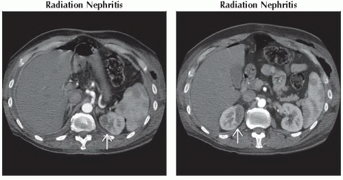 DA15-DB1-Wedge_shaped_or_Striated_Nephrogram-FFU7.gif | Abdominal Key