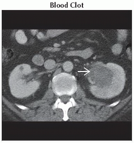 DA15-DB2-Radiolucent_Filling_Defect_Renal_Pelvis-FFU2.gif | Abdominal Key