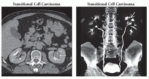 DA15-DB2-Radiolucent_Filling_Defect_Renal_Pelvis-FFU3.gif | Abdominal Key