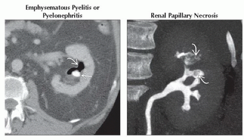 DA15-DB2-Radiolucent_Filling_Defect_Renal_Pelvis-FFU4.gif | Abdominal Key