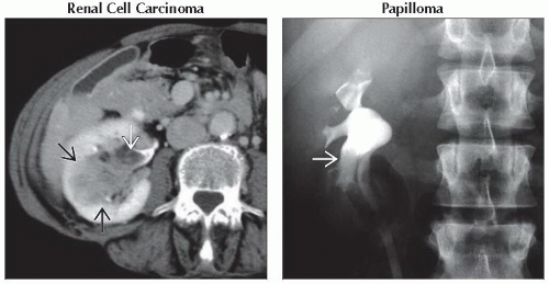 DA15-DB2-Radiolucent_Filling_Defect_Renal_Pelvis-FFU5.gif | Abdominal Key