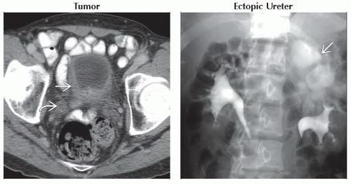 DA16-DB1-Cystic_Dilation_of_Distal_Ureter-FFU3.gif | Abdominal Key