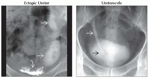 DA16-DB1-Cystic_Dilation_of_Distal_Ureter-FFU4.gif | Abdominal Key