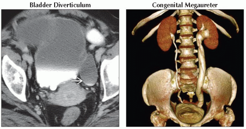 DA16-DB1-Cystic_Dilation_of_Distal_Ureter-FFU5.gif | Abdominal Key