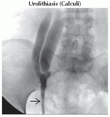 DA16-DB1-Ureteral_Filling_Defect_or_Stricture-FFU2.gif | Abdominal Key