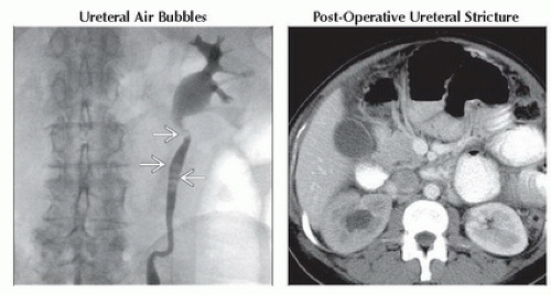 DA16-DB1-Ureteral_Filling_Defect_or_Stricture-FFU3.gif | Abdominal Key