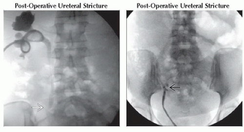 DA16-DB1-Ureteral_Filling_Defect_or_Stricture-FFU4.gif | Abdominal Key