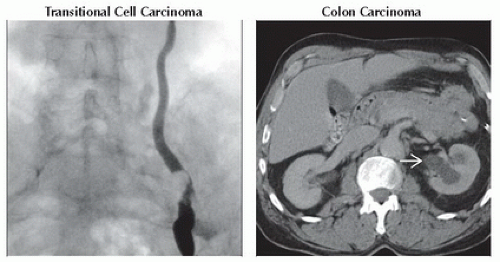 DA16-DB1-Ureteral_Filling_Defect_or_Stricture-FFU6.gif | Abdominal Key