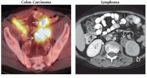 DA16-DB1-Ureteral_Filling_Defect_or_Stricture-FFU7.gif | Abdominal Key