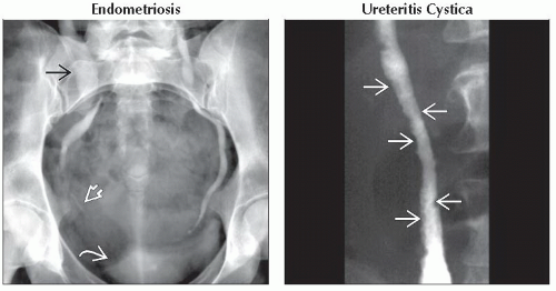 DA16-DB1-Ureteral_Filling_Defect_or_Stricture-FFU8.gif | Abdominal Key