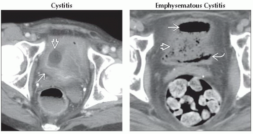 DA17-DB1-Filling_Defect_in_Urinary_Bladder-FFU11.gif | Abdominal Key