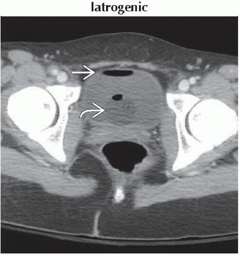 DA17-DB1-Gas_within_Urinary_Bladder-FFU1.gif | Abdominal Key