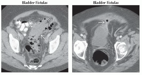 DA17-DB1-Gas_within_Urinary_Bladder-FFU4.gif | Abdominal Key