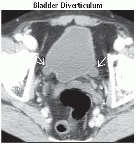 DA17-DB1-Urinary_Bladder_Outpouching-FFU1.gif | Abdominal Key