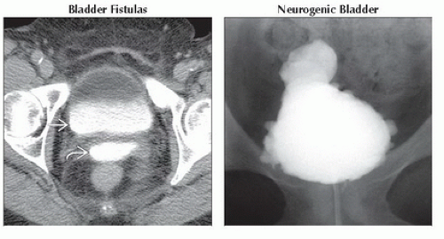 DA17-DB1-Urinary_Bladder_Outpouching-FFU3.gif | Abdominal Key