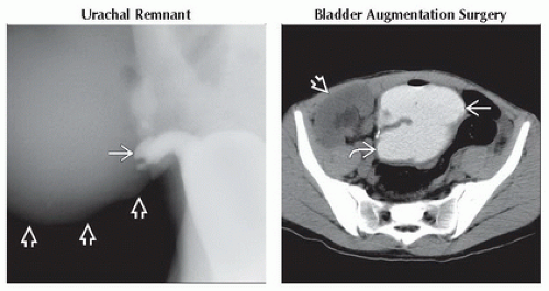 DA17-DB1-Urinary_Bladder_Outpouching-FFU5.gif | Abdominal Key
