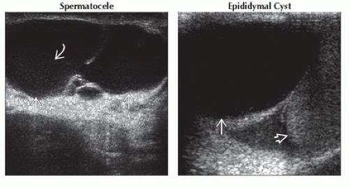 DA19-DB1-Extratesticular_Cystic_Mass-FFU3.gif | Abdominal Key
