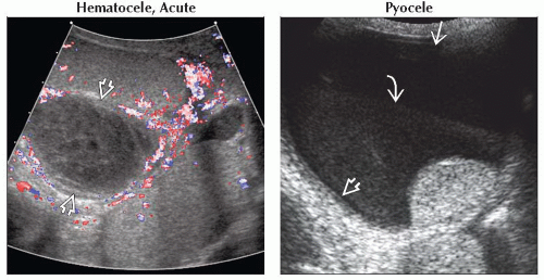 DA19-DB1-Extratesticular_Cystic_Mass-FFU5.gif | Abdominal Key