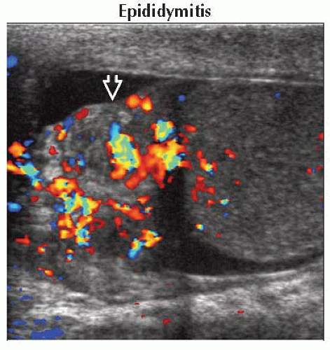 DA19-DB1-Extratesticular_Solid_Mass-FFU1.gif | Abdominal Key