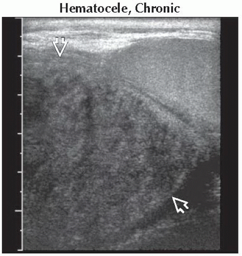 DA19-DB1-Extratesticular_Solid_Mass-FFU2.gif | Abdominal Key