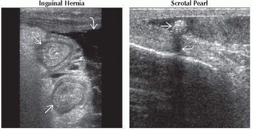 DA19-DB1-Extratesticular_Solid_Mass-FFU3.gif | Abdominal Key