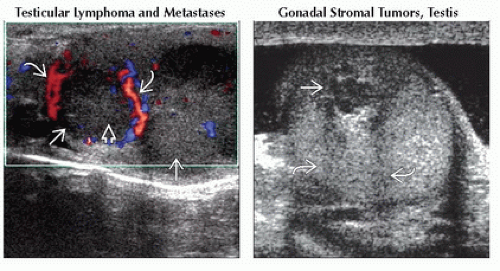 DA19-DB1-Intratesticular_Mass-FFU7.gif | Abdominal Key