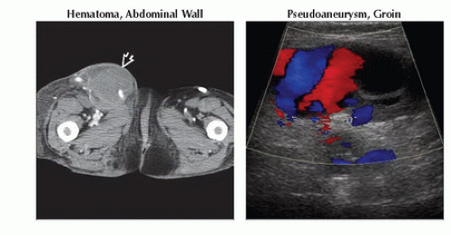 DA2-DB1-Groin_Mass-FFU3.gif | Abdominal Key