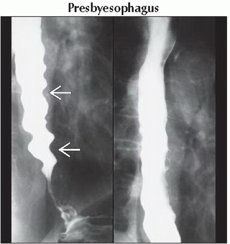 DA3-DB1-Esophageal_Dysmotility-FFU1.gif | Abdominal Key